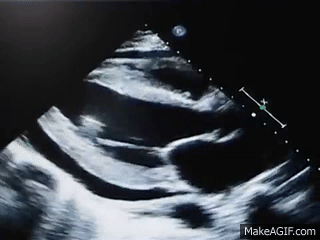 Pericardial Effusion and Cardiac Tamponade on Make a GIF